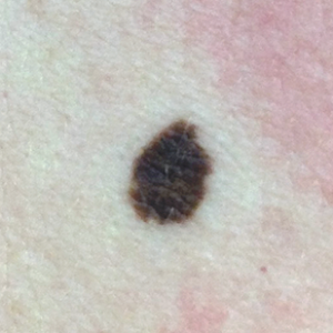 Skin Cancer | Complete Overview of Symptoms & Types