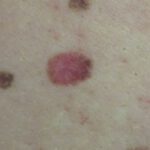 Normal moles pictures library | Wide overview for comparison