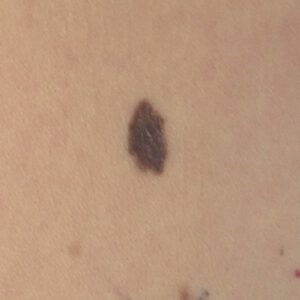 Normal moles pictures library | Wide overview for comparison