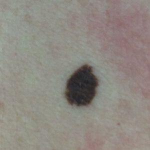 Normal moles pictures library | Wide overview for comparison